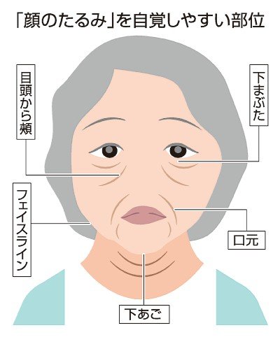 お医者さんに聞いてみよう（41）顔のたるみが気になる 佐武利彦さん（富山大付属病院形成再建外科・美容外科診療部門長）｜北日本新聞webunプラス
